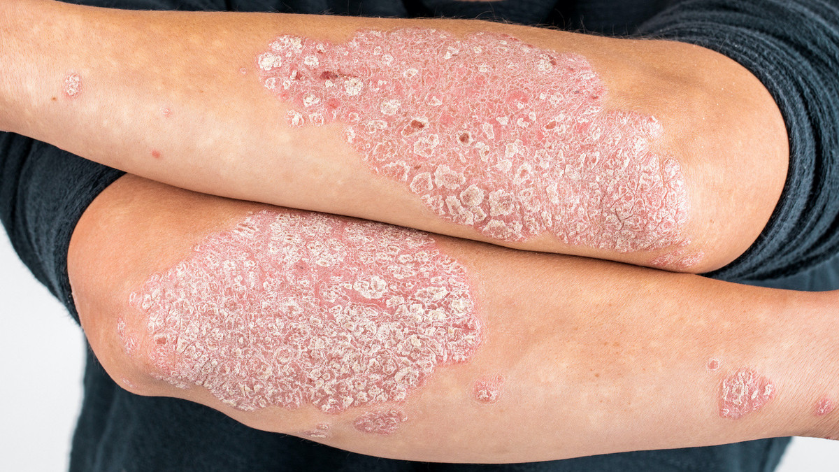 Keratoson comp.: Infectopharm bringt Fixkombi bei Psoriasis | APOTHEKE ...