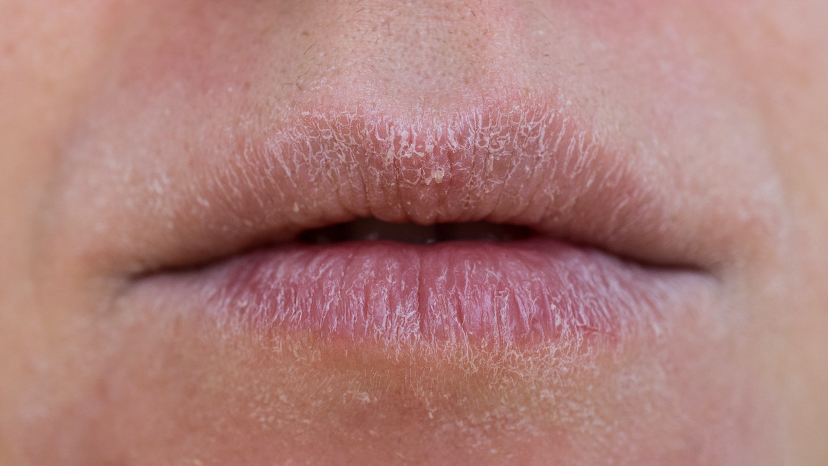 Öle gegen spröde Lippen | APOTHEKE ADHOC
