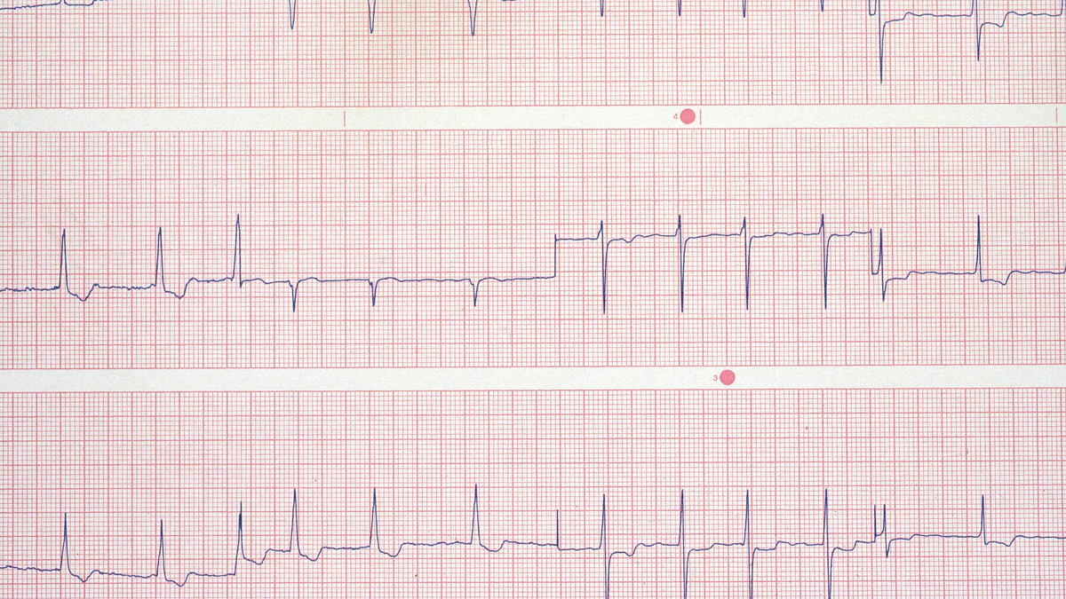 QT-Zeit: Was steckt dahinter? | APOTHEKE ADHOC