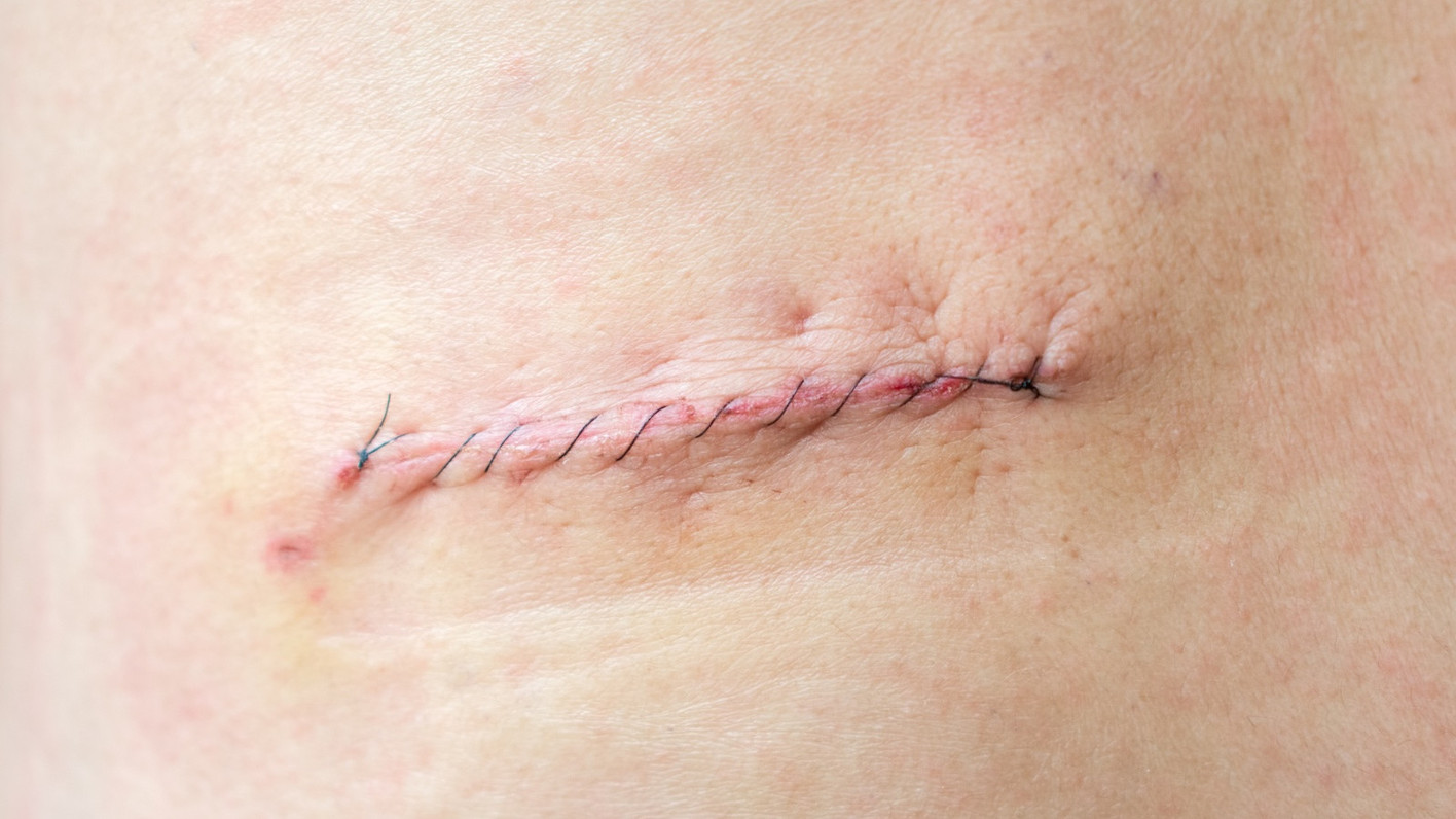 Narben nach der OP: Richtig gepflegt heilt besser | APOTHEKE ADHOC