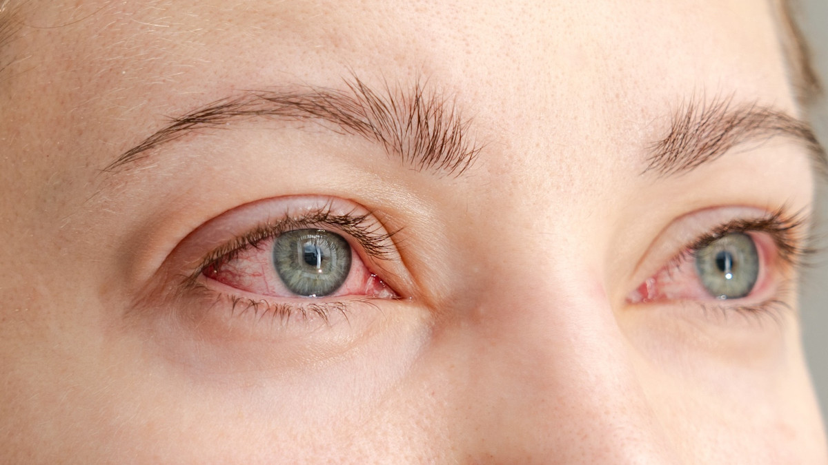 Bindehautentzündung: Tipps für die Beratung | APOTHEKE ADHOC