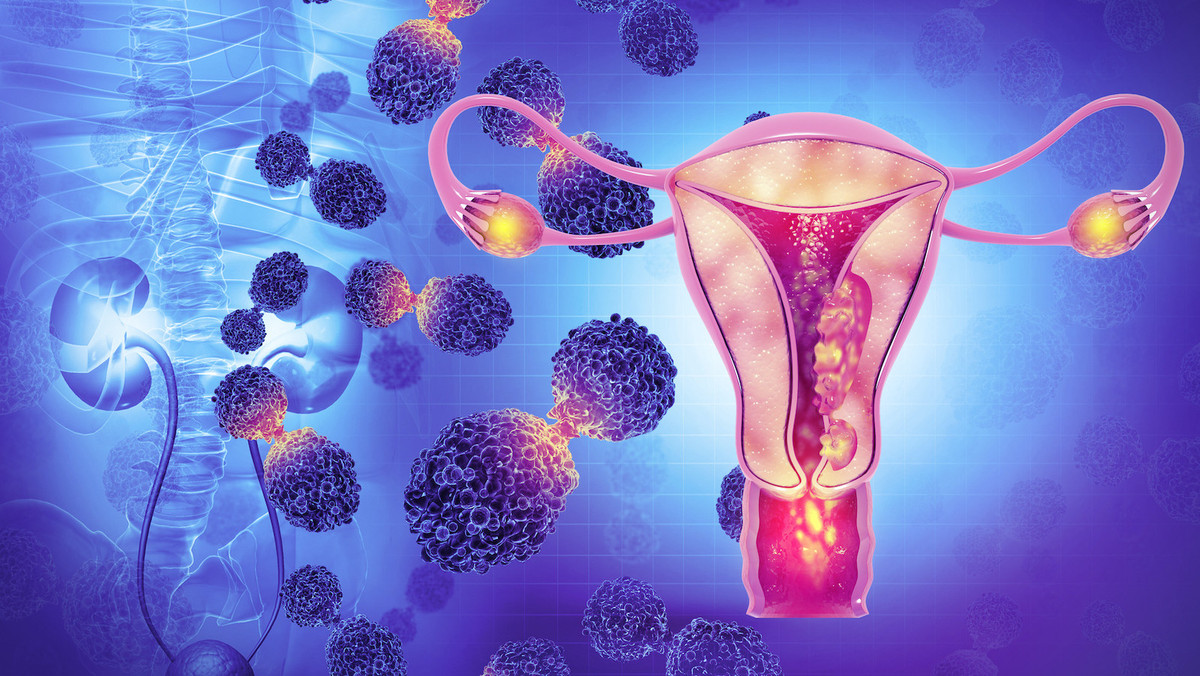 Endometriose: Spielen Fusobakterien eine Rolle? | APOTHEKE ADHOC