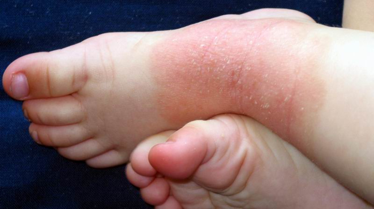 Skilarence: Systemisches Dimethylfumarat | APOTHEKE ADHOC