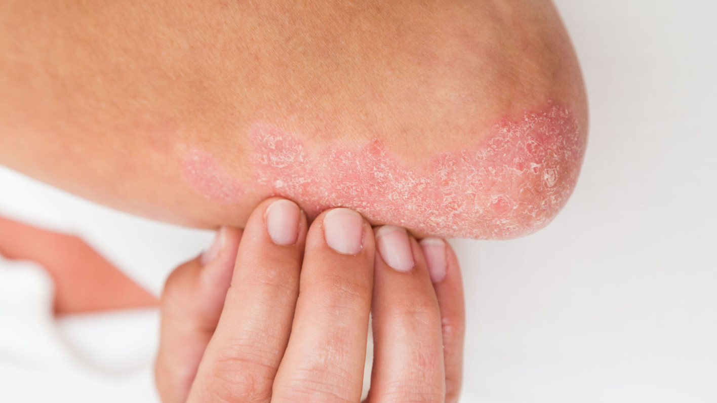 UCB launcht Bimzelx | APOTHEKE ADHOC