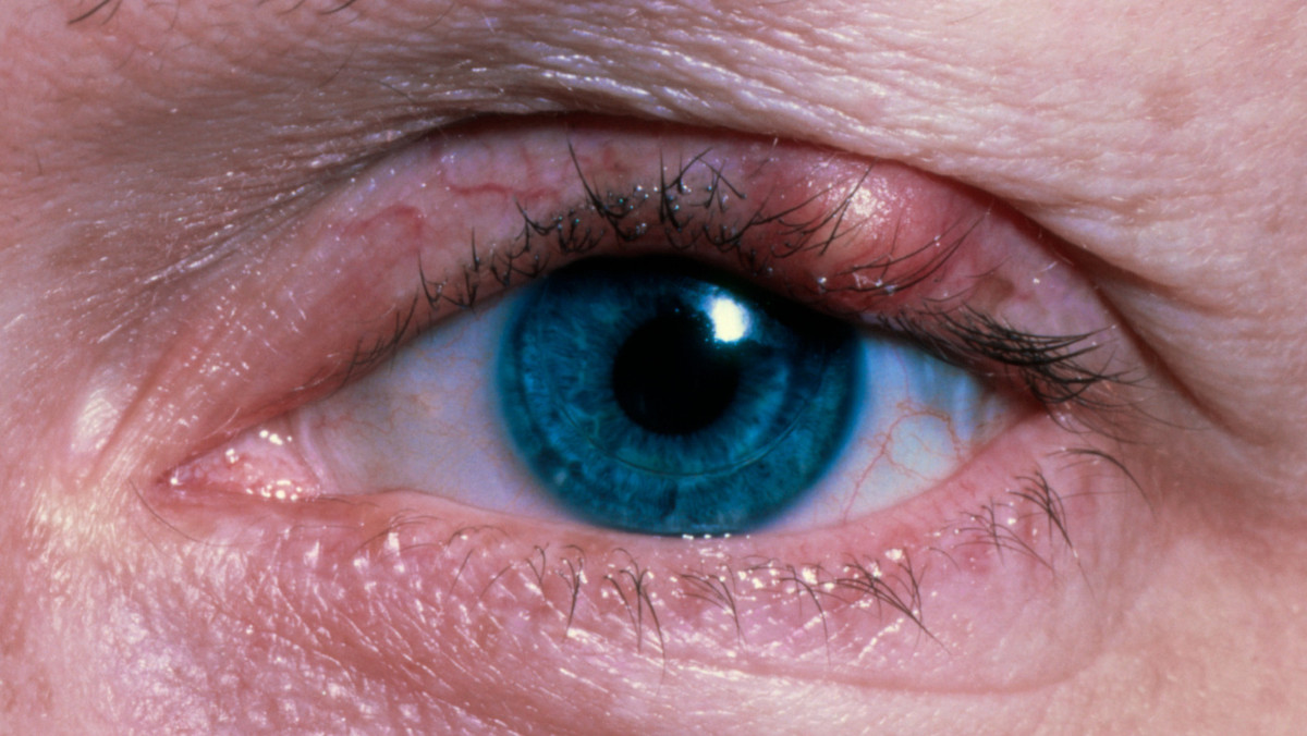 Gerstenkorn: Hochansteckend, aber gut heilbar | APOTHEKE ADHOC