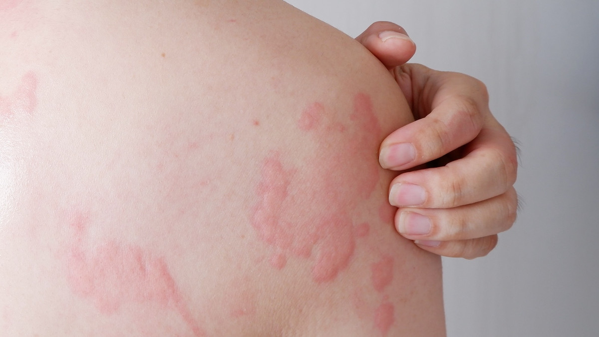 Urtikaria: Nächste Indikation für Kassenschlager Dupixent? | APOTHEKE ADHOC