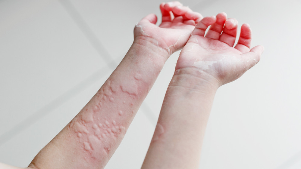 Nesselsucht nach Booster-Impfung | APOTHEKE ADHOC